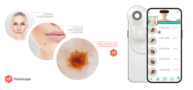 Dermatoscopy | An Evolving Process For Benefiting All