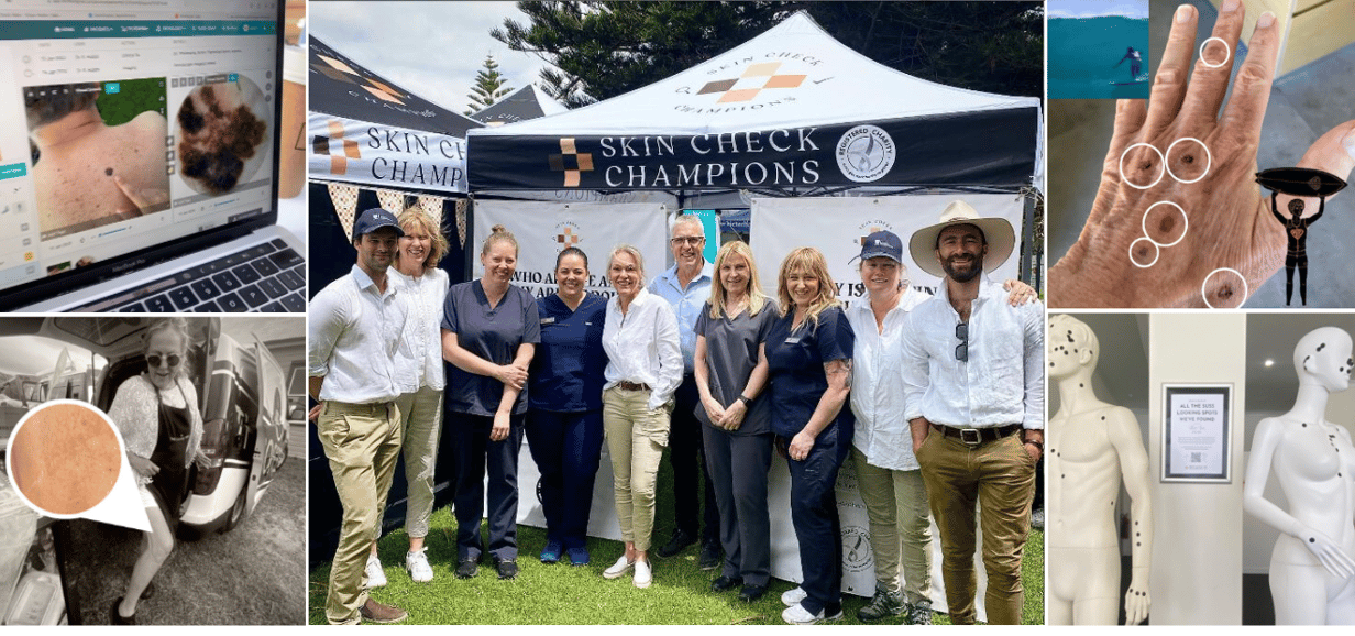 Early Detection Saving Lives | Our Partnership with Skin Check Champions