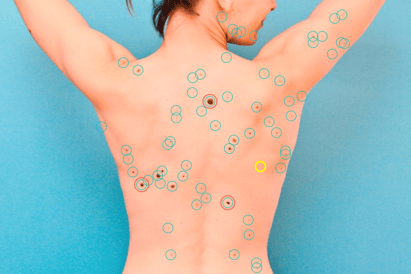 Educating Your Patients on Total Body Photography