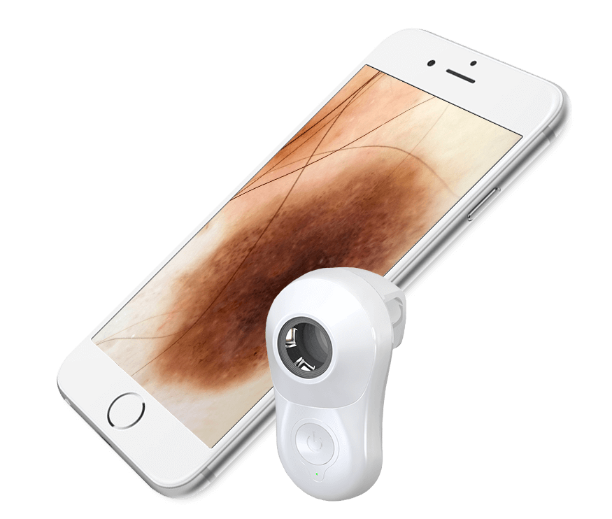Top 6 Reasons To Upgrade To A Mobile Dermoscope